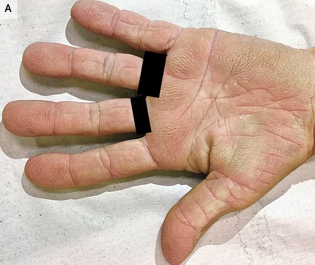 Acanthosis palmaris: wygląd dłoni zdradził raka płuca [zdjęcia ...
