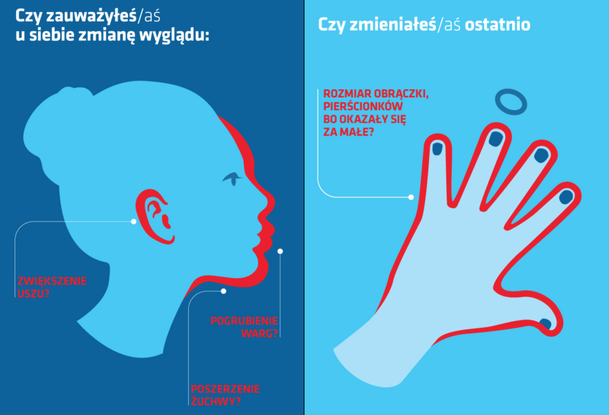 Akromegalia: Tajemnicza choroba, którą trudno zdiagnozować - Zdrowie ...